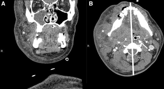 Parapharyngeal abscess with tracheal deviation | SpringerLink