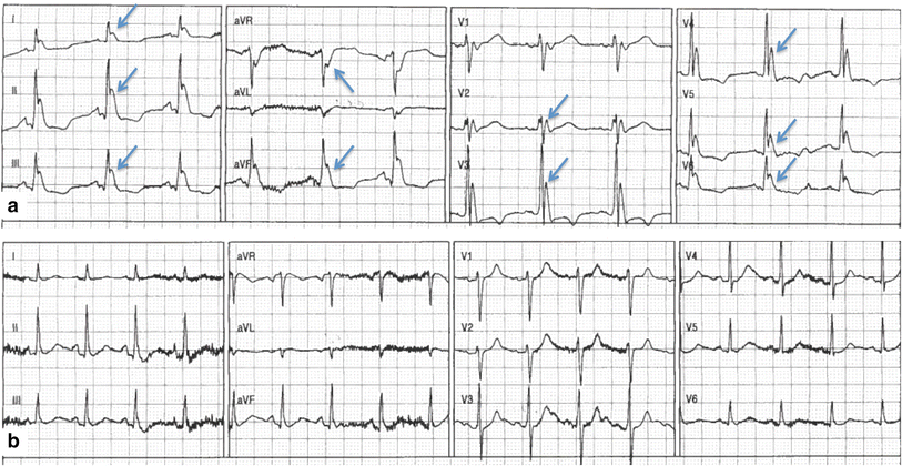 A very cool electrocardiogram: Osborn waves of hypothermia | SpringerLink