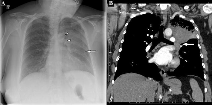 Hiding behind the veil: an ominous chest X-ray | SpringerLink