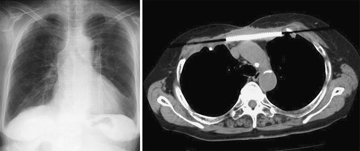 Anterior chest wall reconstruction with titanium plate sandwiched ...
