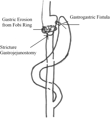 Self-expanding stents in treatment of esophageal leaks post bariatric ...