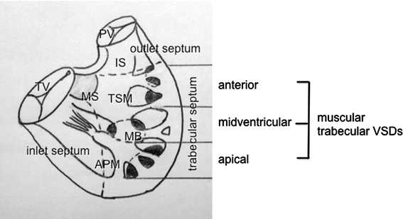 Techniques and results in the management of multiple muscular ...