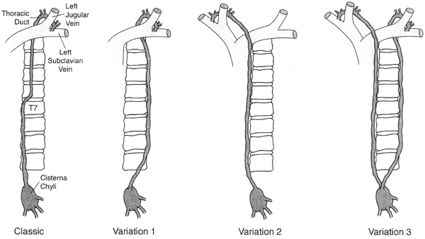 Chylothorax after coronary artery bypass grafting using the right ...