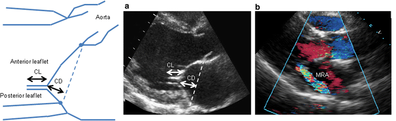 Post-repair coaptation length and durability of mitral valve repair for ...