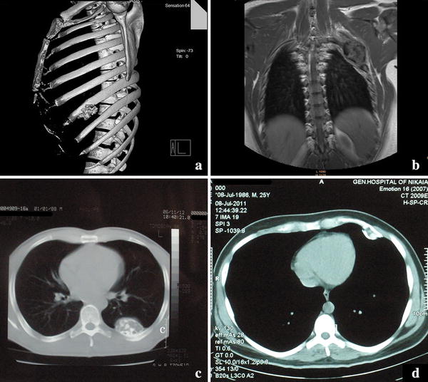 Rib tumors: a 15-year experience | SpringerLink