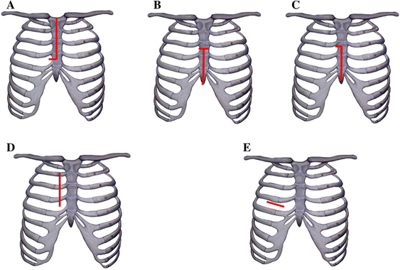 Minimally invasive surgery of mitral valve (MIS-MV) | SpringerLink
