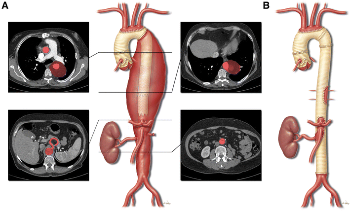Open aortic surgery after thoracic endovascular aortic repair ...