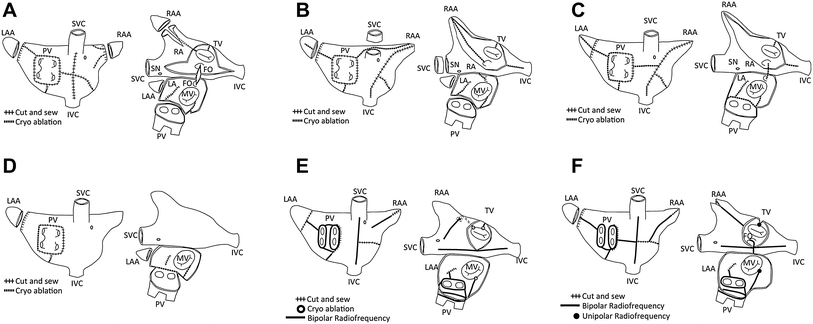 Development of the Maze procedure and the contribution of Japanese ...