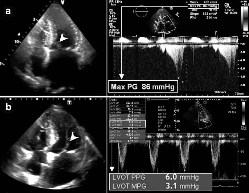 Concomitant septal myectomy during minimally invasive aortic valve ...