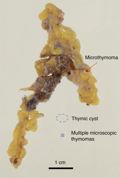 Microthymoma and microscopic thymomas associated with a thymic cyst ...