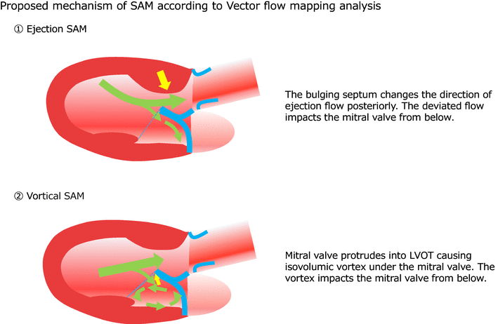 Management of systolic anterior motion of the mitral valve: a mechanism ...