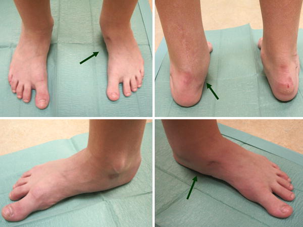Relapsed clubfoot correction with soft-tissue release and selective ...