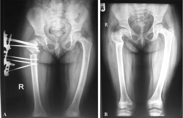 Valgus osteotomy by external fixation for treatment for developmental ...
