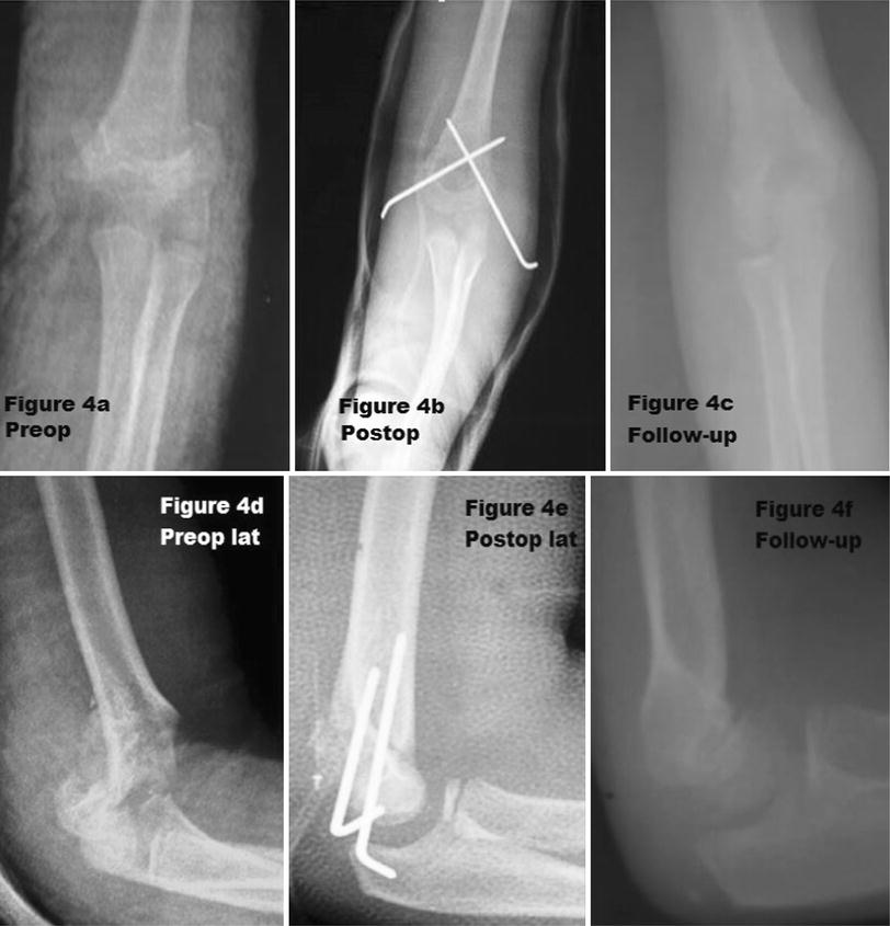 Open reduction and pinning for the treatment of Gartland extension type ...