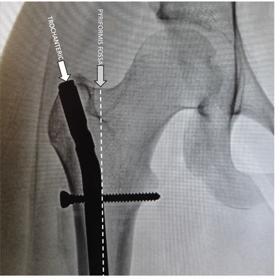 Percutaneous rotational osteotomy of the femur utilizing an ...
