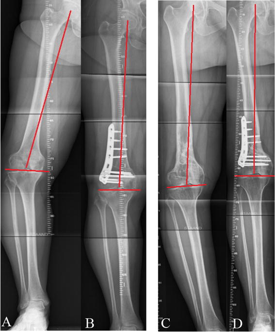 Distal femoral valgus osteotomy: bone healing time in single plane and ...