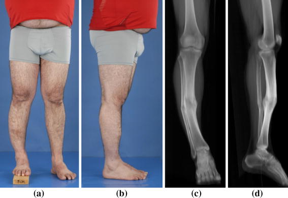 Computer-assisted oblique single-cut rotation osteotomy to reduce a ...