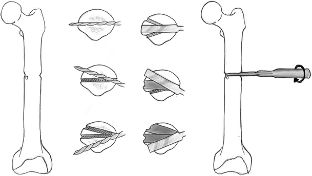 The history, evolution and basic science of osteotomy techniques ...