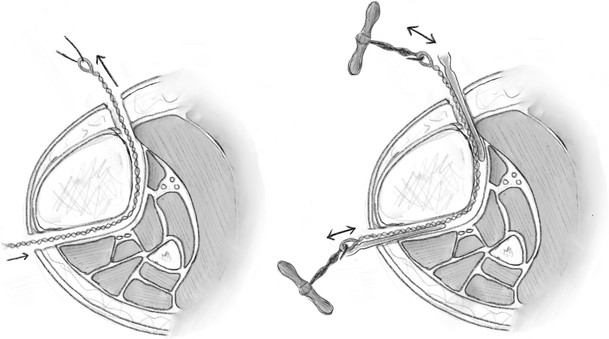 The history, evolution and basic science of osteotomy techniques ...