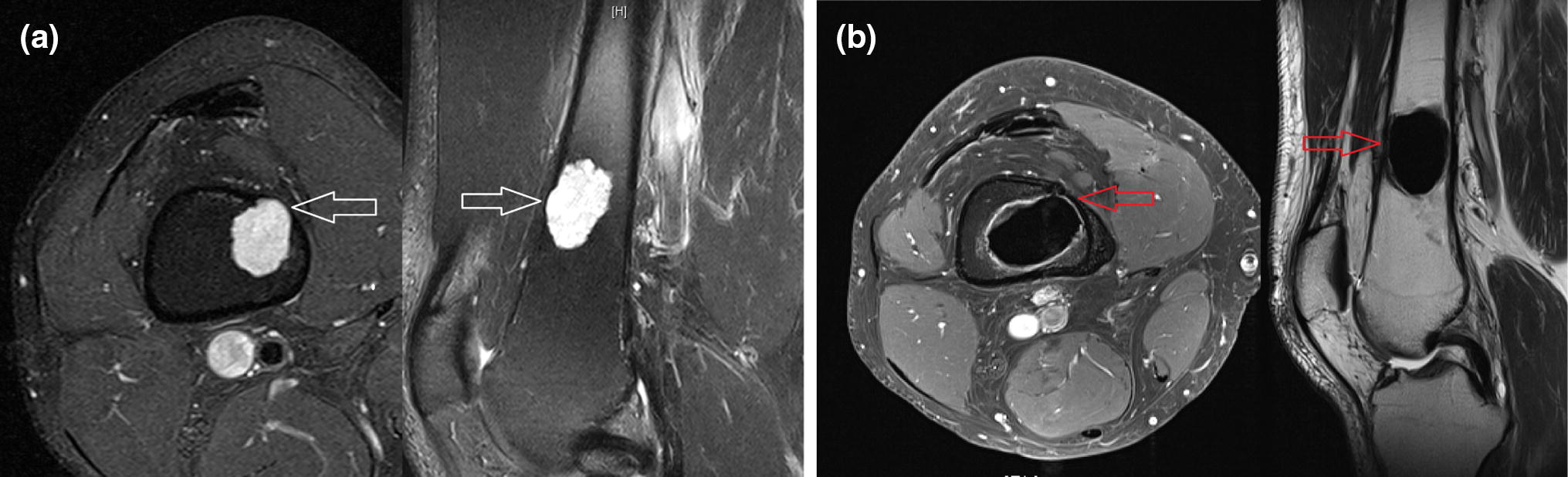 Surgical therapy of benign and low-grade malignant intramedullary ...