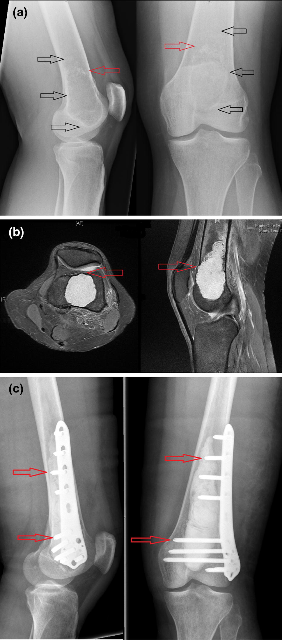 Surgical therapy of benign and low-grade malignant intramedullary ...
