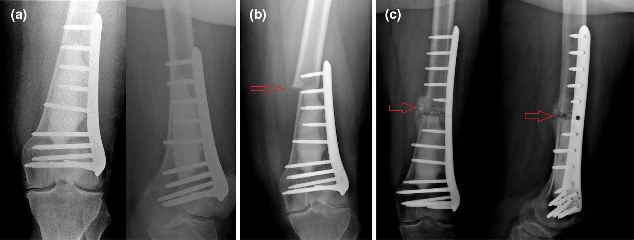 Surgical therapy of benign and low-grade malignant intramedullary ...