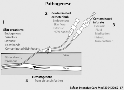 Gefäßkatheter-assoziierte Infektionen | SpringerLink