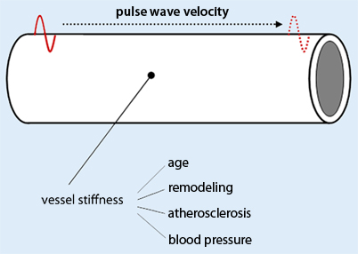Continuous blood pressure measurement using pulse transit time ...