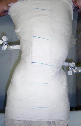 Scoliosis in-brace curve correction and patient preference of CAD/CAM ...