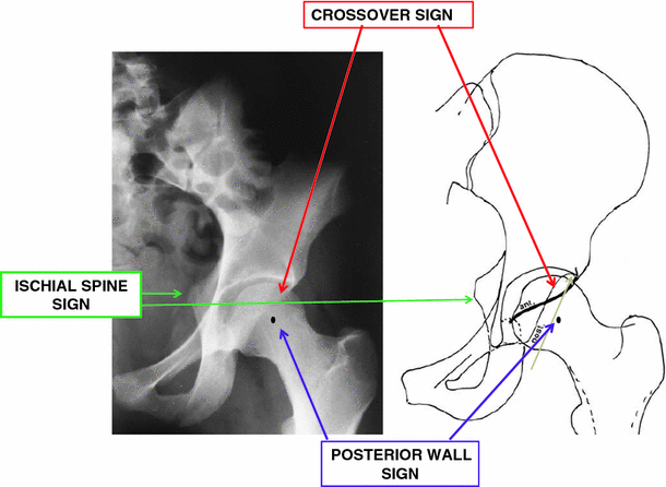 Femoro-acetabular impingement: the diagnosis—a review | SpringerLink