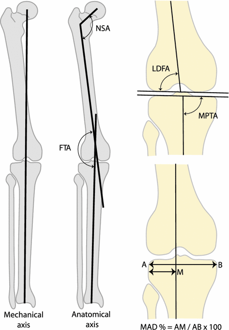 Does proximal femoral varus osteotomy in Legg–Calvé–Perthes disease ...