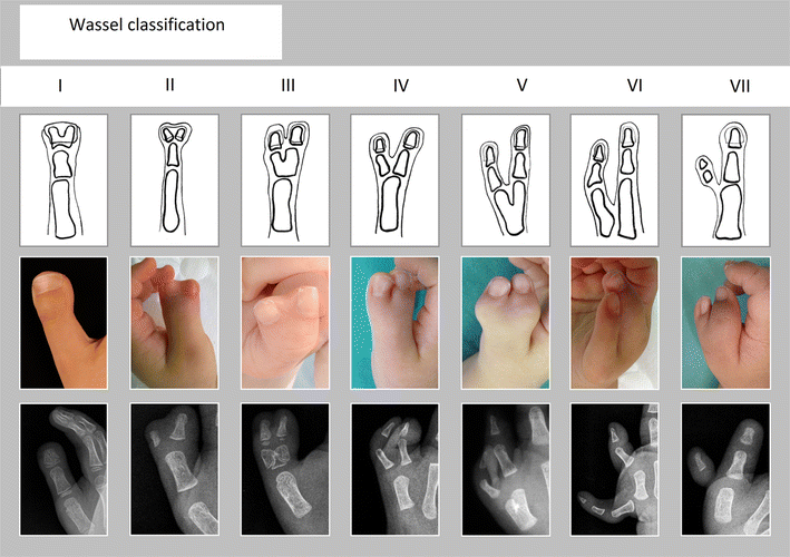 Prognostic value of age and Wassel classification in the reconstruction ...
