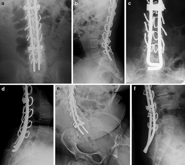 Posterior spinal fusion to sacrum in non-ambulatory hypotonic ...