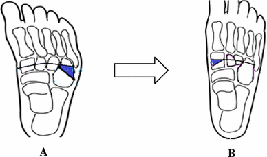 Combined double tarsal wedge osteotomy and transcuneiform osteotomy for ...
