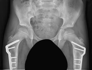 Cannulated, locking blade plates for proximal femoral osteotomy in ...