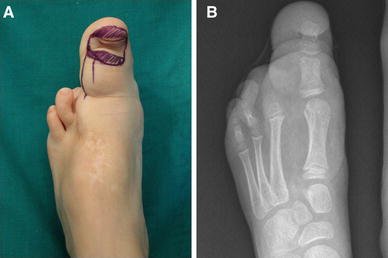 Island nail flap in the treatment of foot macrodactyly of the first ray ...
