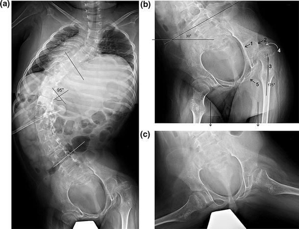 Simultaneous progression patterns of scoliosis, pelvic obliquity, and ...