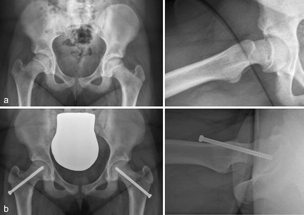 Arthroscopic osteochondroplasty in patients with mild slipped capital ...