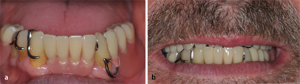 Ästhetik in der herausnehmbaren Prothetik | SpringerLink