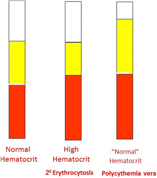 Polycythemia Vera | SpringerLink