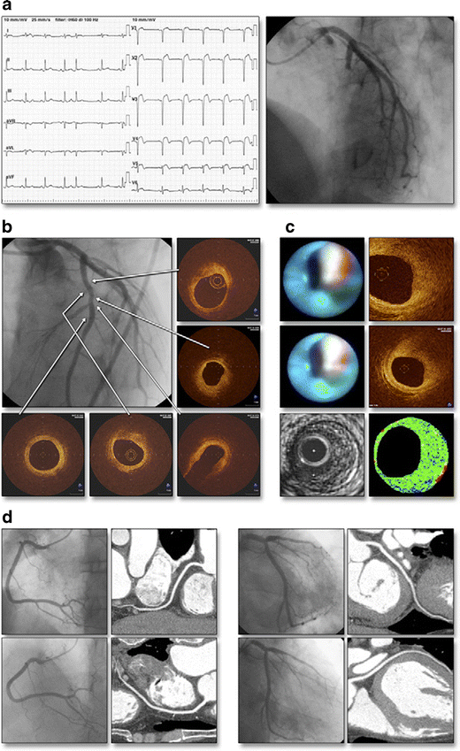 Imaging Atherosclerosis and Risk of Plaque Rupture | SpringerLink