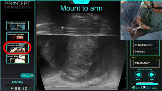 The Aquabeam System: a Review | SpringerLink