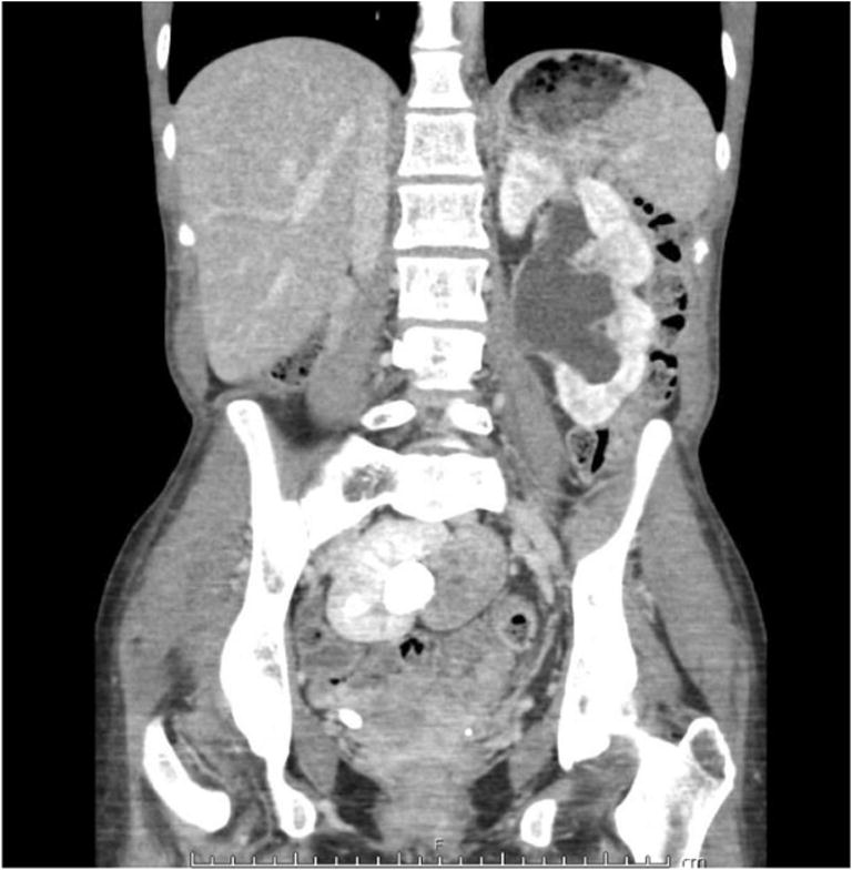The Inflammatory Contracted Bladder | SpringerLink