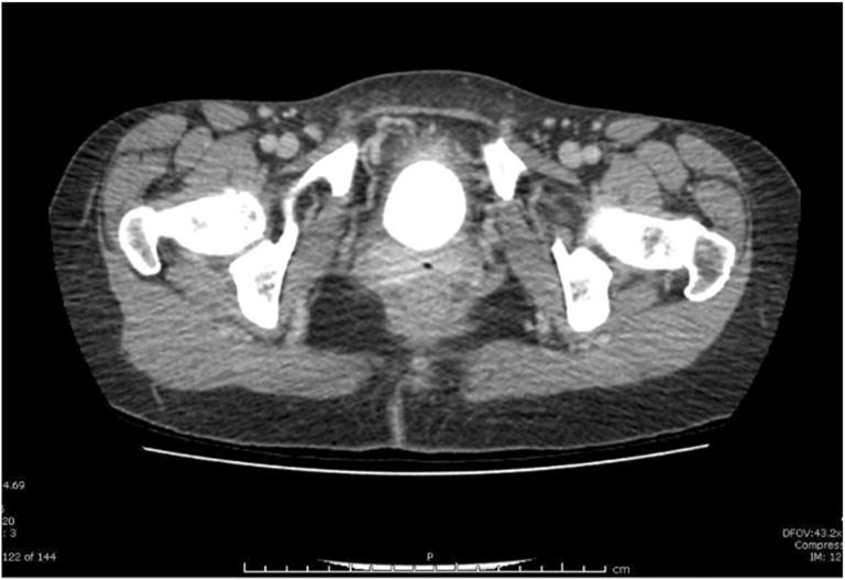 The Inflammatory Contracted Bladder | SpringerLink