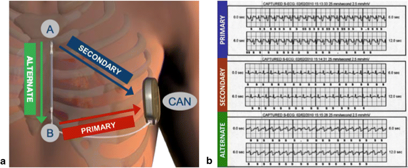Early Experience with the Subcutaneous ICD | SpringerLink