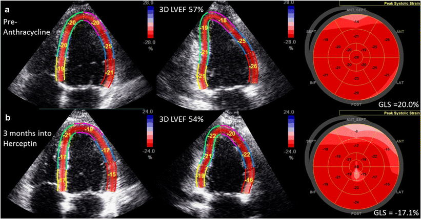 Cardiotoxicity Due to Chemotherapy: Role of Cardiac Imaging | SpringerLink