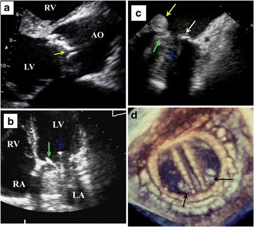 Echocardiographic Evaluation of Prosthetic Heart Valves | SpringerLink