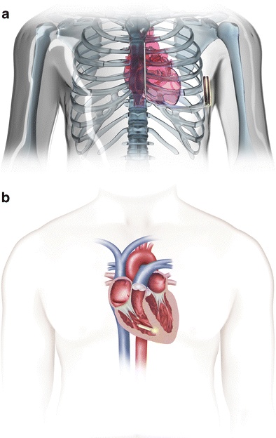Prevention, Diagnosis, and Treatment of Cardiac Implantable Electronic ...