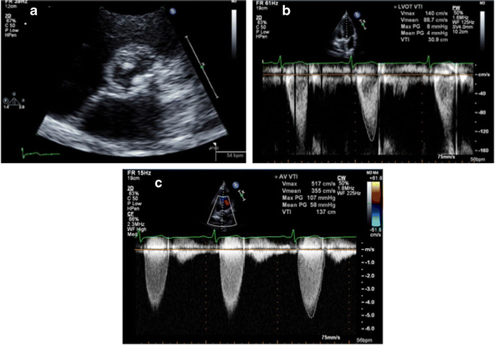 Echocardiography in Pregnancy: Part 2 | SpringerLink