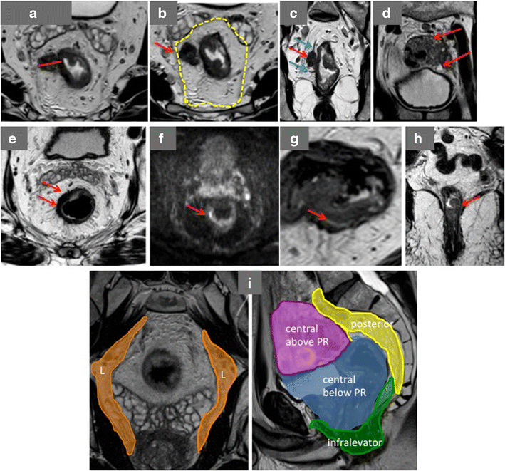Imaging Advances in Colorectal Cancer | SpringerLink